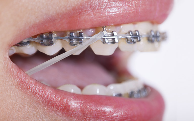 Memorándum Restricción Ocho brackets con puntos de colores eliminar ... Memorándum Restricción Ocho brackets con puntos de colores eliminar ...